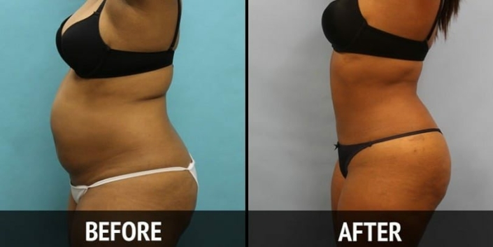 How Much Does Liposuction Cost? - ThePricer Media How Much Does Liposuction Cost? - ThePricer Media