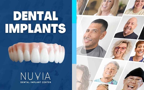 How Much Do Nuvia Dental Implants Cost?